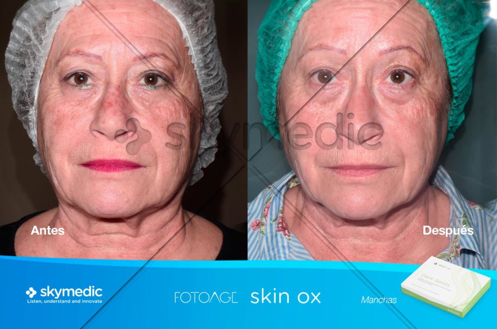 SKINOX - RESULTADOS - ANTES DESPUES 1 - Clínica Nexus